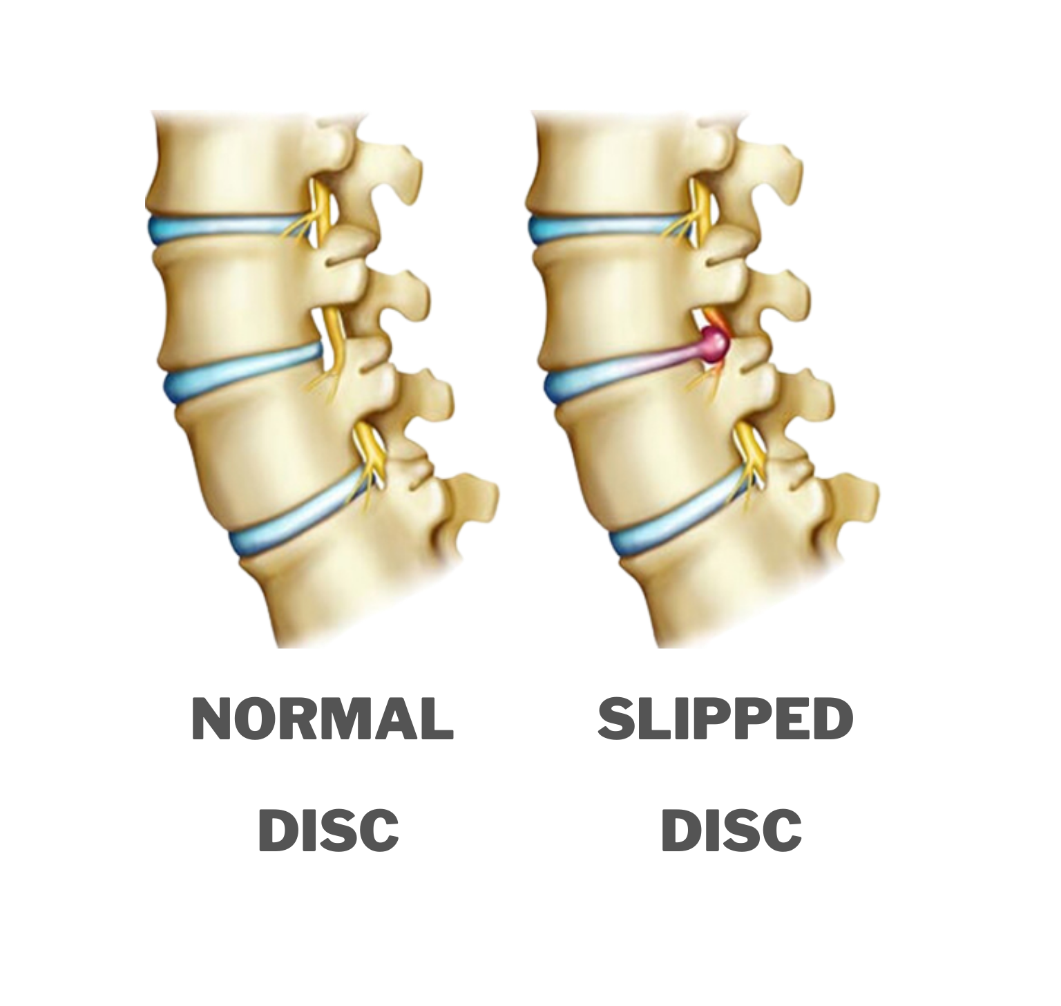 Slipped Disc Therapy Singapore Pain Clinic Wellness Philosophy Slipped Disc Therapy Singapore Pain Clinic Wellness Philosophy