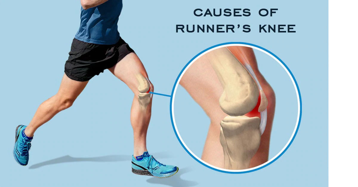  Runner s Knee PT 